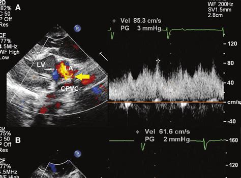 Spectral Doppler Ultrasound Definition Definition Hjo