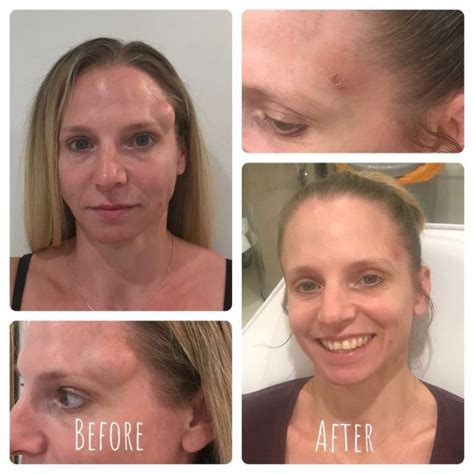 Before After Botox Facial Fillers And Minor Surgery Results