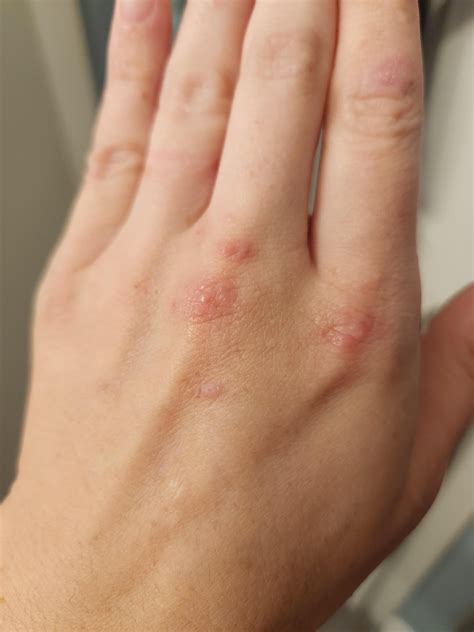 Got Shingles At 43 On Torso Rshingles Got Shingles At 43 On Torso Rshingles