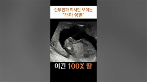 산부인과 의사는 초음파 사진만 보고 성별을 맞출 수 있을까 Youtube