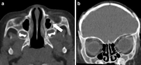 Early Maxillary Sinus Development In An 8 Month Old Girl A B Axial Download Scientific