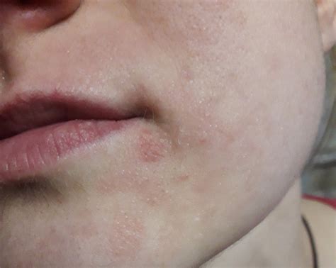 Красные шелушащиеся пятна на лице Вопрос дерматологу 03 Онлайн