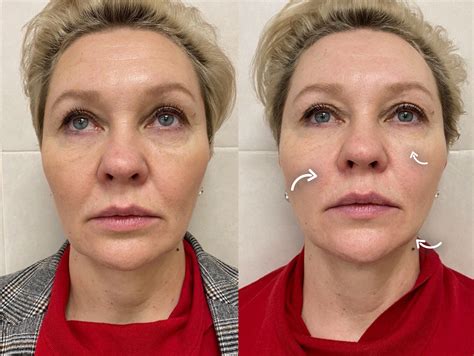 Smas Лифтинг Фото До И После — Фото Картинки