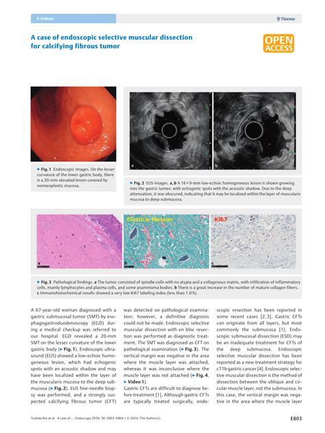 Pdf A Case Of Endoscopic Selective Muscular Dissection For Calcifying