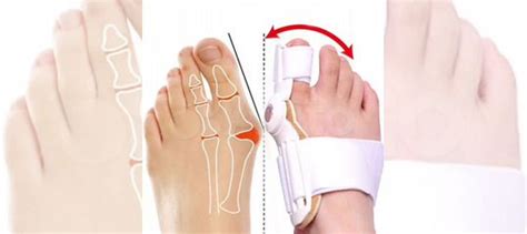 Вальгусная шарнирная шина 2шт выпрямитель пальца купить в Санкт ...