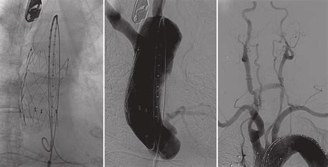 Fluoroscopy After Stent Graft Deployment A Completion Angiogram In
