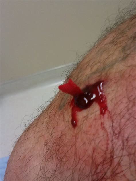 Bug Bite Vs Staph Infection