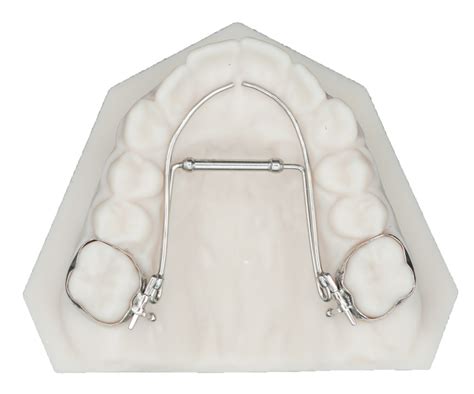 Palatal Expander 20 Years Old At Amanda Unger Blog