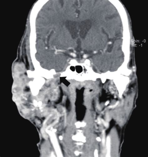 The Main Specimen From The Preauricular Area Consisted Of A Nodular Download Scientific