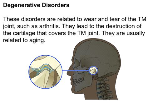 Tmj Disorders