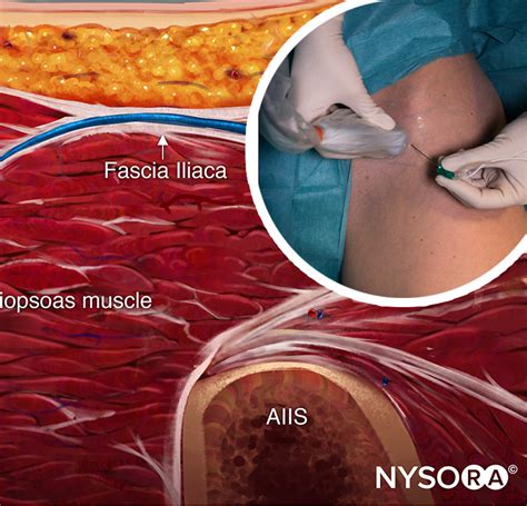 Ultrasound Guided Fascia Iliaca Nerve Block NYSORA NYSORA
