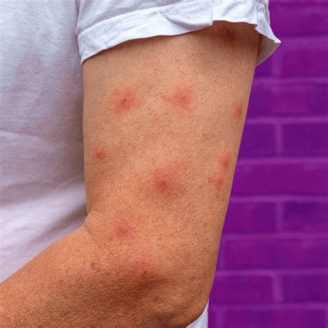 Are These Bed Bug Bites Signs Symptoms And What To Do