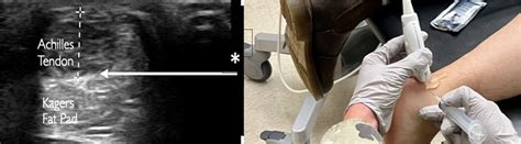 Axial View Of Achilles Tendon Left And Procedure Positioning Right