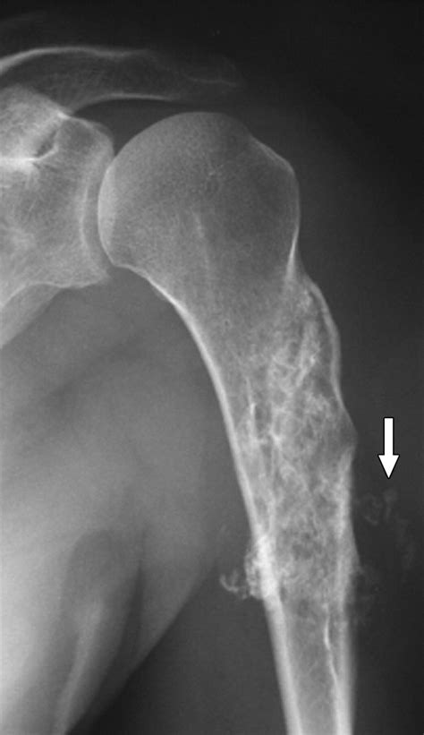Chondroma In Knee X Ray Chondroma In Knee X Ray