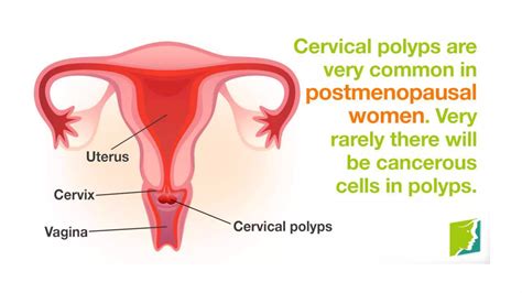 Benign Cervical Lesions Pptx