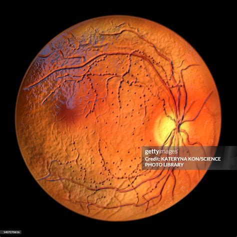 Retina Damage From Diabetes Illustration High Res Vector Graphic