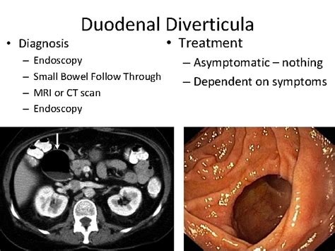 Diverticula Of The Alimentary Tract Aaron Sinclair Md