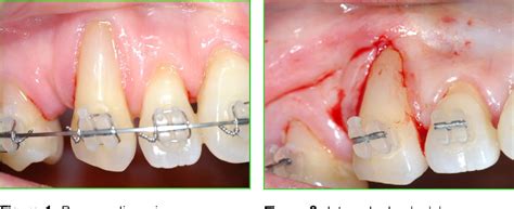 Figure 1 From Root Coverage Using Subepithelial Connective Tissue Graft Semantic Scholar