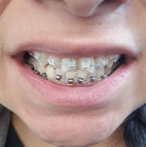 Braces At 30 Day 1 Scrolller