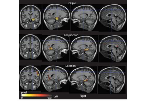 Statistical Maps Indicating P Value Of Correlation Between Cortical