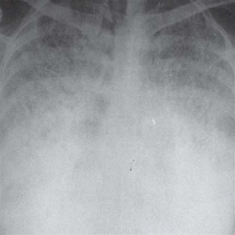 CT Thorax Lung Window Showing Diffuse Intra Alveolar Opacities Of Download Scientific Diagram
