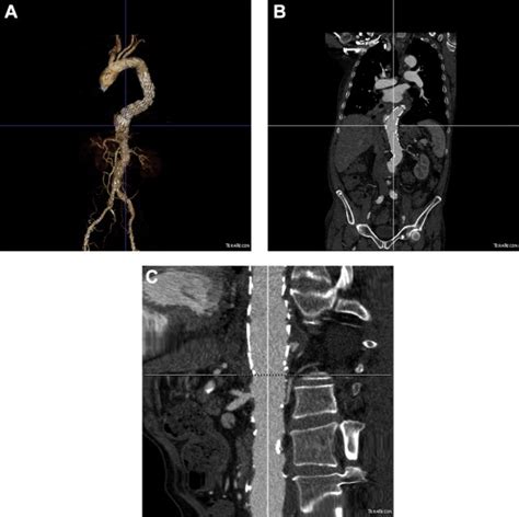 A Distal Type I Endoleak Is Shown After The First Procedure On The Download Scientific Diagram
