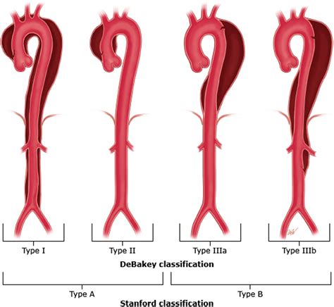 aortic dissection anesthesiology clinics