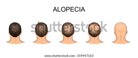 Illustration Male Head Alopecia Stock Vector Royalty Free Shutterstock
