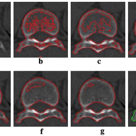 Automatic Initialization By Otsu Threshold A Original Image B