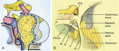 Trigeminal Cave Of Dura