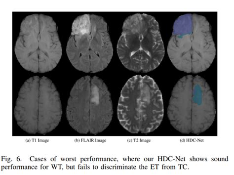 Hdc Net Hierarchical Decoupled Convolution Network For Brain Tumor
