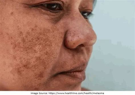 Hyperpigmentation After Co2 Laser Kdc Clinic