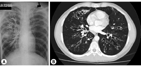 A Bronchographic Image Showing Central Bronchiectasis With Normal