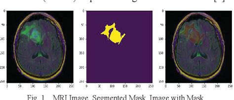 Figure 1 From Brain Tumor Detection Using Resnet Architectures Semantic Scholar