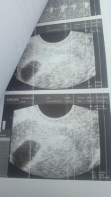 Vamos Brincar Descobrir Sexo Do Beb Com Semanas M Todo Ranzi Page Babycenter