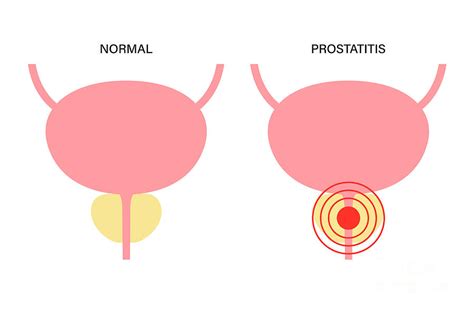 Prostatitis By Science Photo Library