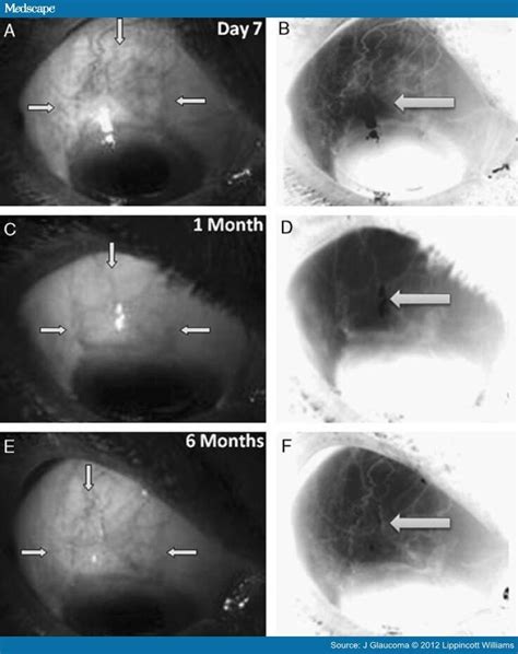 Bevacizumab Vs Mitomycin C In Phacotrabeculectomy Page 3