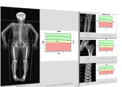 Bone Density Testing Monument Imaging And Diagnostic Center