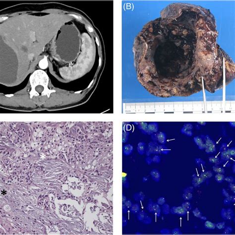 A Cystic Lesion With Capsule In Segment 7 Of The Liver B Liver Download Scientific Diagram