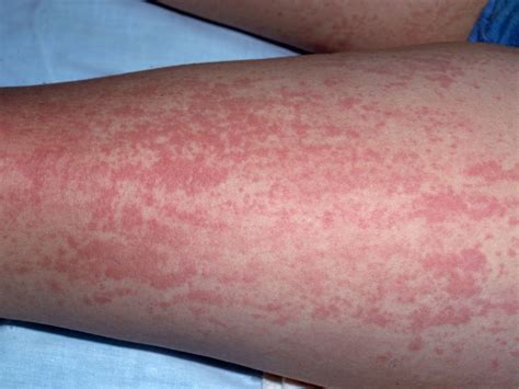 Full Body Rash In Adults When To Worry About A Rash In Adults 8 Skin