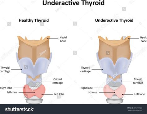 Underactive Thyroid Gland Explained Helios 3000