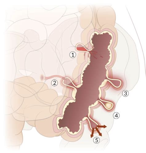 Patho Of Small Intestines Colon And Appendix Flashcards Quizlet