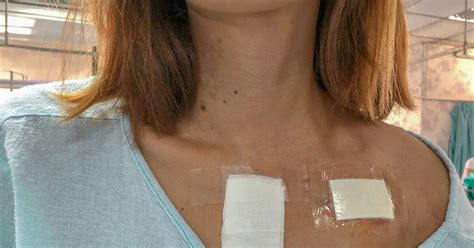 Placing A Pacemaker In Women