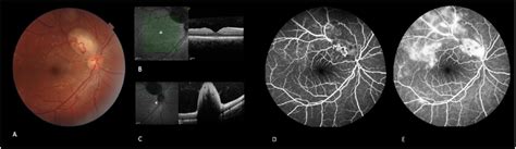 Fundus Examination Was Conducted Six Months After Initial Presentation