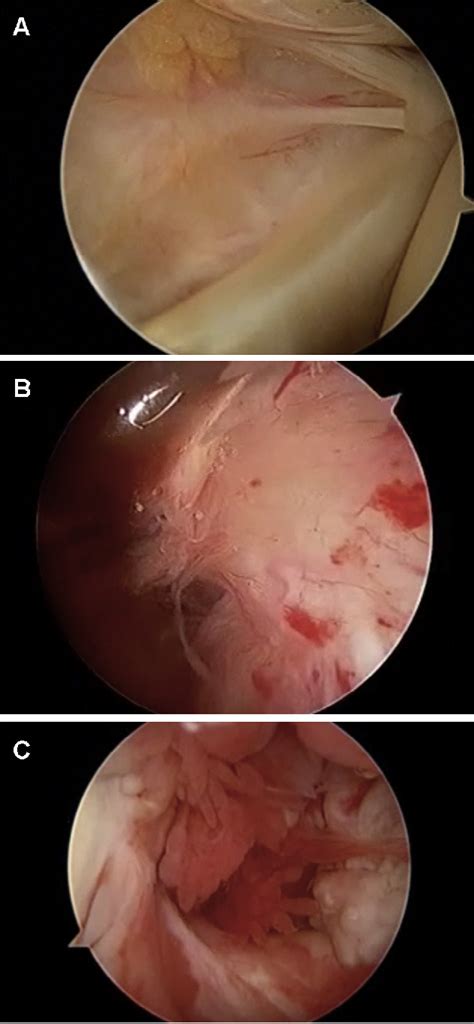 Shoulder Synovitis Semantic Scholar