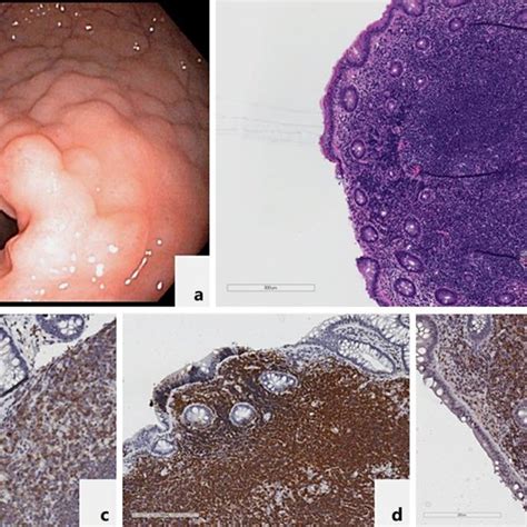 Staging Colonoscopy Findings A Colonoscopy With Multiple Colonic Download Scientific Diagram