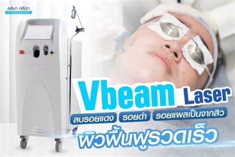 เลเซอร์ วีบีม Vbeam Laser คืออะไร ช่วยลดรอยจากสิวได้จริงไหม Laliza Clinic