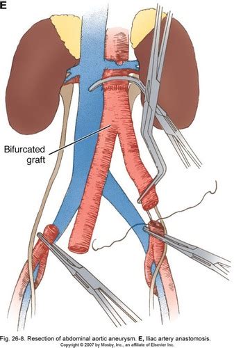 Abdominal Aortic Aneurysm Resection Flashcards Quizlet