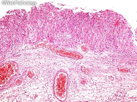 Hyperreactio Luteinalis Gross And Microscopic