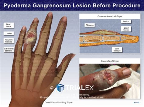 Pyoderma Gangrenosum Lesion Before Procedure Trialquest Inc